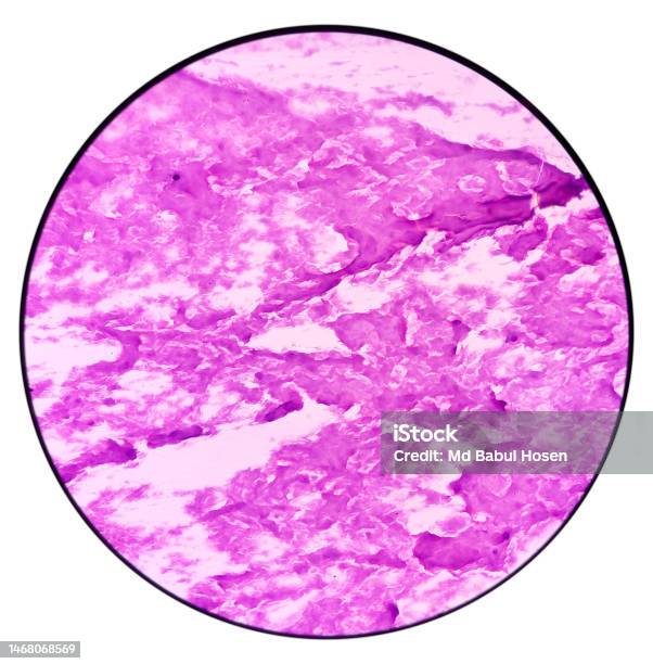 Scalp Swelling Cytology Epidermal Inclusion Cyst Commonly Called Sebaceous Cyst Showing