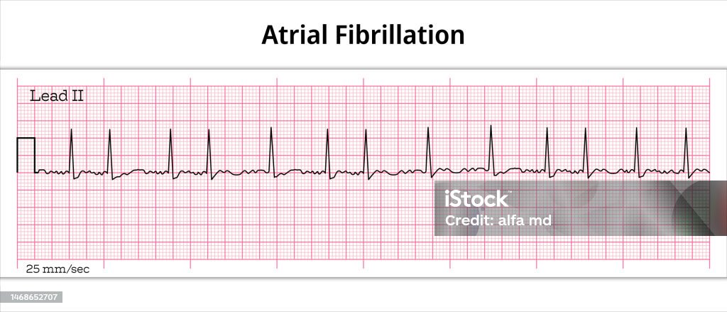 Fibrilasi Atrium Ekg Kertas Ekg 8 Detik Ilustrasi Stok - Unduh Gambar ... Fibrilasi Atrium Ekg Kertas Ekg 8 Detik Ilustrasi Stok - Unduh Gambar ...