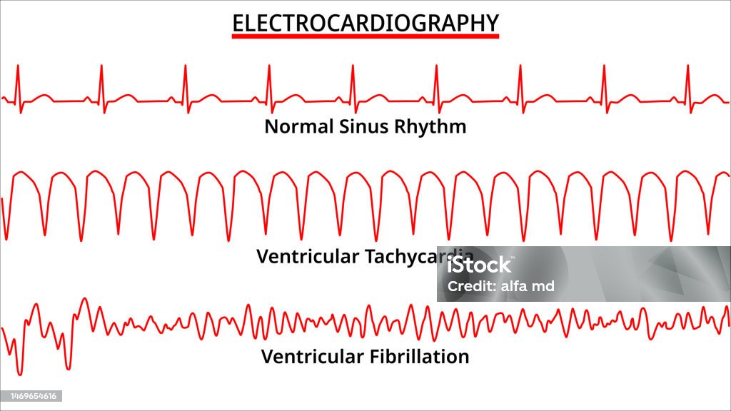 Set Of Ecg Common Abnormalities Ventricular Tachycardia Vs Ventricular ... Set Of Ecg Common Abnormalities Ventricular Tachycardia Vs Ventricular ...