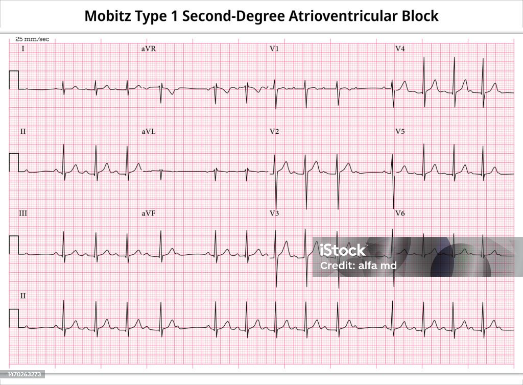Mobitz Type 1 Second Degree Atrioventricular Block Ecg Paper 12 Lead ... Mobitz Type 1 Second Degree Atrioventricular Block Ecg Paper 12 Lead ...