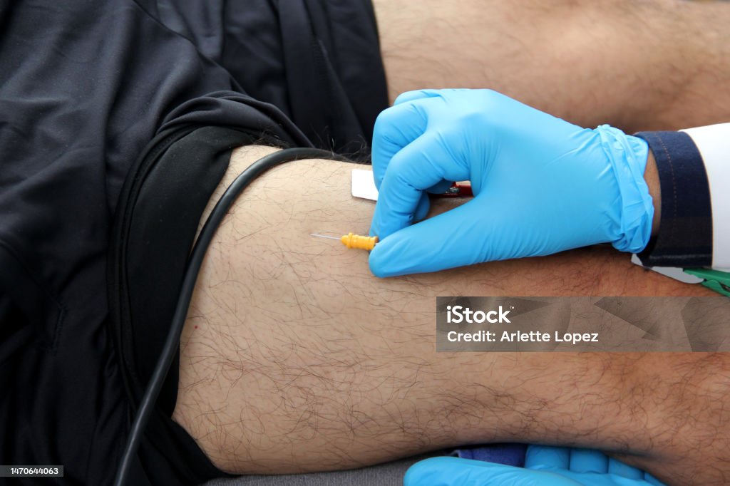Electromyography Emg And Somatosensory Evoked Potential Pev Of Lower