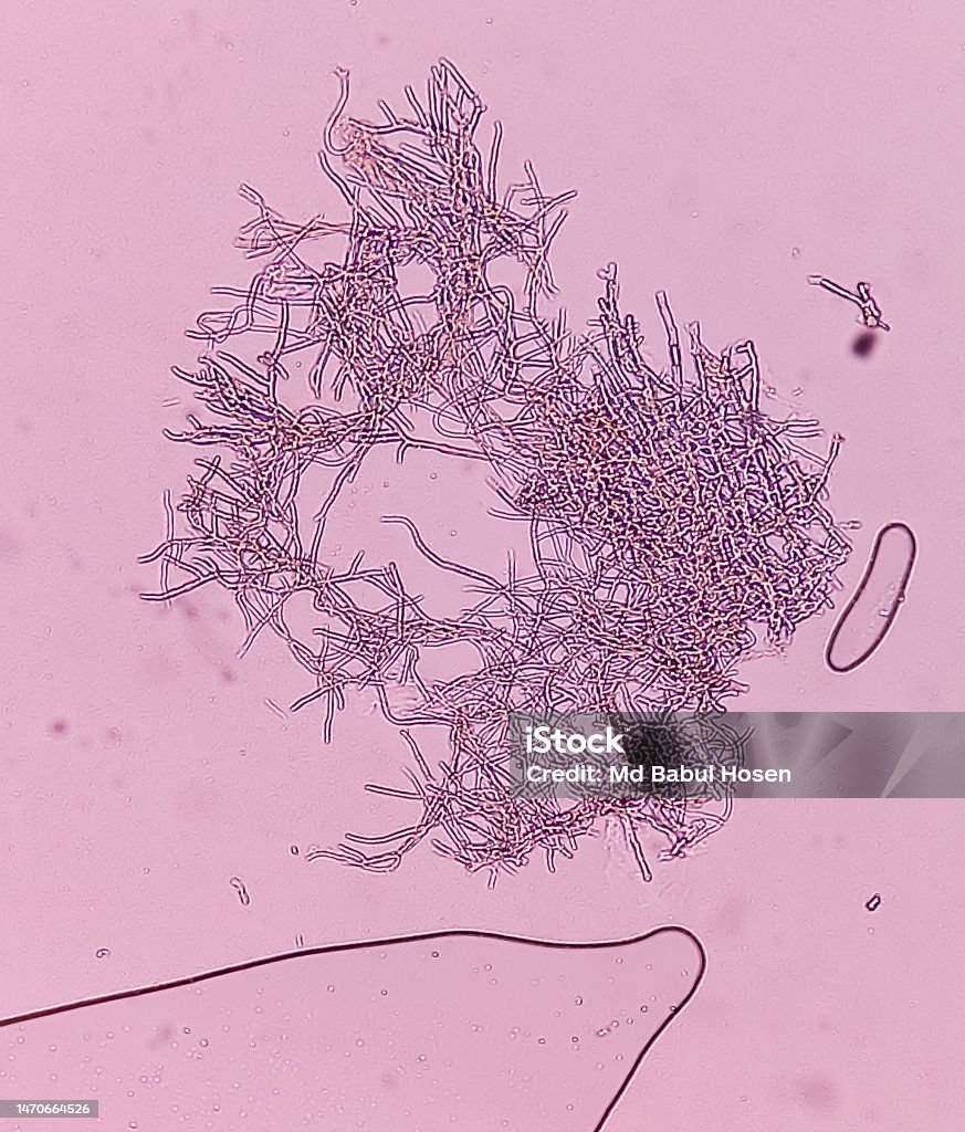 Microscopic Fungi Malassezia Furfur Showing Yeast Cells And Hyphae Dermatophytes Nail Scraping