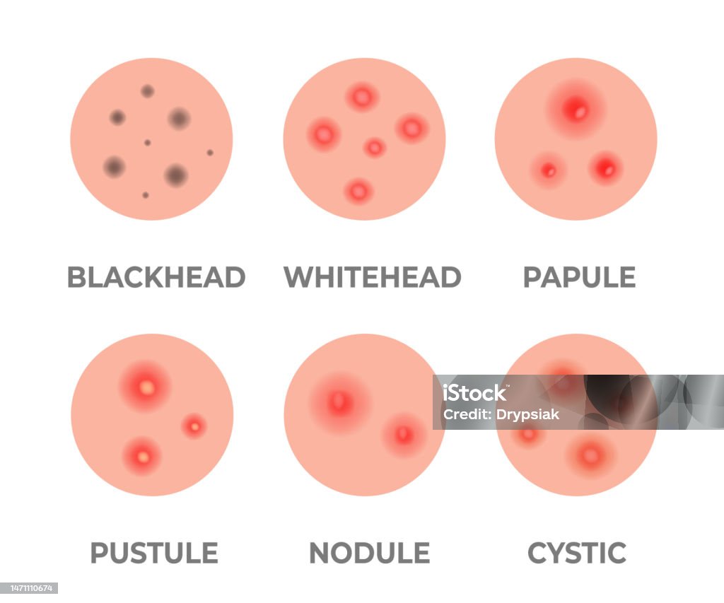 Types Of Acne Illustration Pimples Skin Pores Blackhead Whitehead Scar