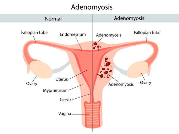 110 Adenomyosis Stock Illustrations Royalty Free Vector Graphics