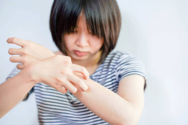 50+ Infected Forearm From Mosquito Bite Stock Photos, Pictures ... 50+ Infected Forearm From Mosquito Bite Stock Photos, Pictures ...