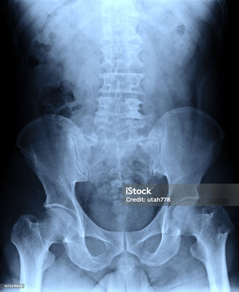 Tulang Belakang Panggul Sendi Pinggul Gambar Xray Foto Stok - Unduh ... Tulang Belakang Panggul Sendi Pinggul Gambar Xray Foto Stok - Unduh ...