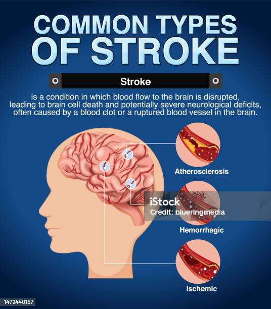 Ilustración de Póster Informativo De Los Tipos Comunes De Stoke y más ... Ilustración de Póster Informativo De Los Tipos Comunes De Stoke y más ...