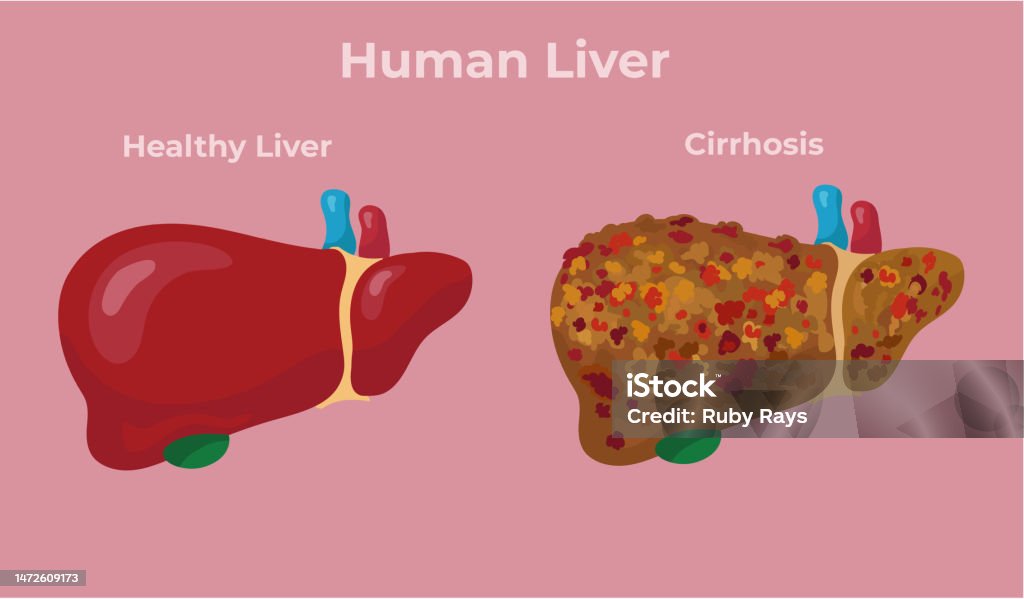 Healthy Liver Vs Cirrhosis Unhealthy Liver Graphic Vector Illustration Stock Illustration