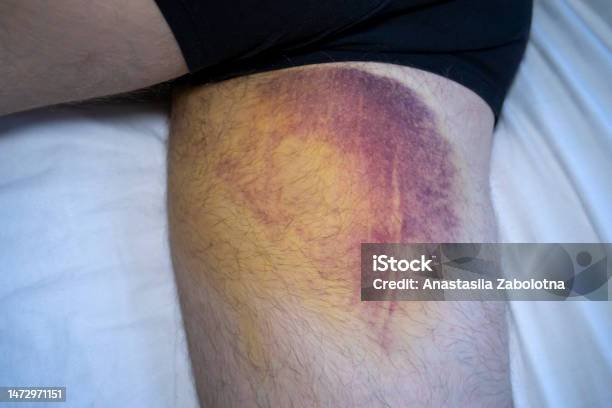 Very Large Bruise On The Inner Thigh Surface Of The Mans Leg Accident