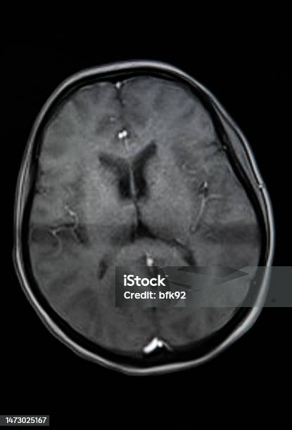 Pemindaian Mri Otak Pemindaian Gambar Resonansi Magnetik Otak Alat ... Pemindaian Mri Otak Pemindaian Gambar Resonansi Magnetik Otak Alat ...