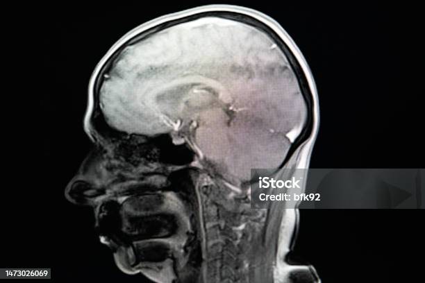 Pemindaian Mri Otak Pemindaian Gambar Resonansi Magnetik Otak Alat ... Pemindaian Mri Otak Pemindaian Gambar Resonansi Magnetik Otak Alat ...