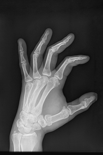 Imagen De Rayos X De Manos Humanas Fractura De Brazo Foto de stock y ... Imagen De Rayos X De Manos Humanas Fractura De Brazo Foto de stock y ...