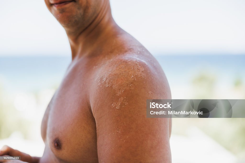 Closeup Of A Red Shoulder And Back Of A Man With A Sunburned Skin Stock