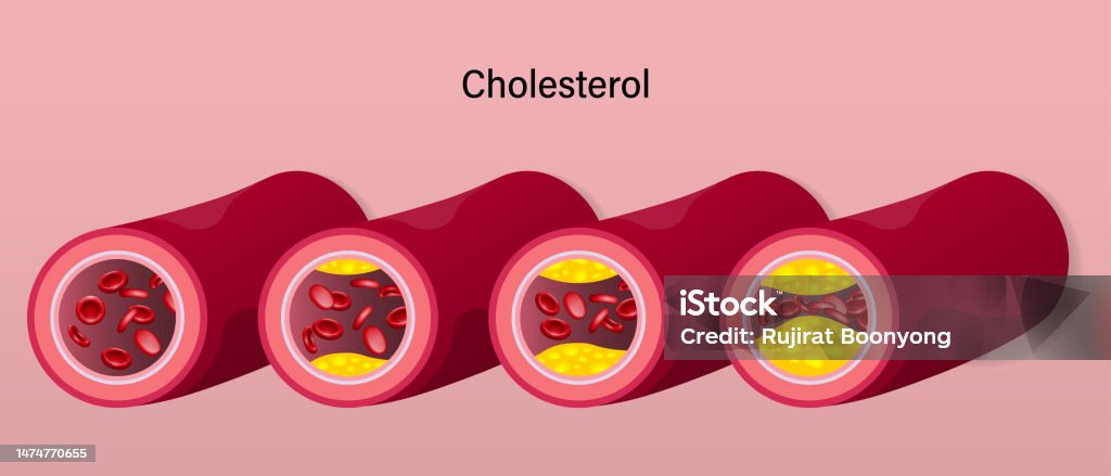 Stage Of Cholesterol Accumulation In Blood Vessels Atherosclerosis ... Stage Of Cholesterol Accumulation In Blood Vessels Atherosclerosis ...