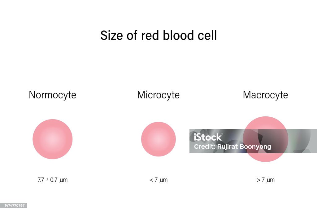 Morfologi Sel Darah Merah Ukuran Sel Darah Merah Anisositosis Ilustrasi ... Morfologi Sel Darah Merah Ukuran Sel Darah Merah Anisositosis Ilustrasi ...