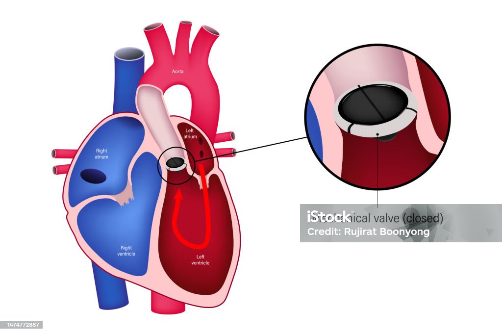 Penggantian Katup Aorta Dengan Katup Mekanis Tutup Katup Mekanis ... Penggantian Katup Aorta Dengan Katup Mekanis Tutup Katup Mekanis ...