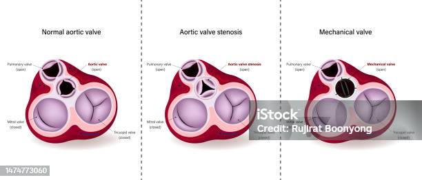 Diagram Katup Aorta Normal Stenosis Katup Aorta Dan Katup Mekanis ... Diagram Katup Aorta Normal Stenosis Katup Aorta Dan Katup Mekanis ...
