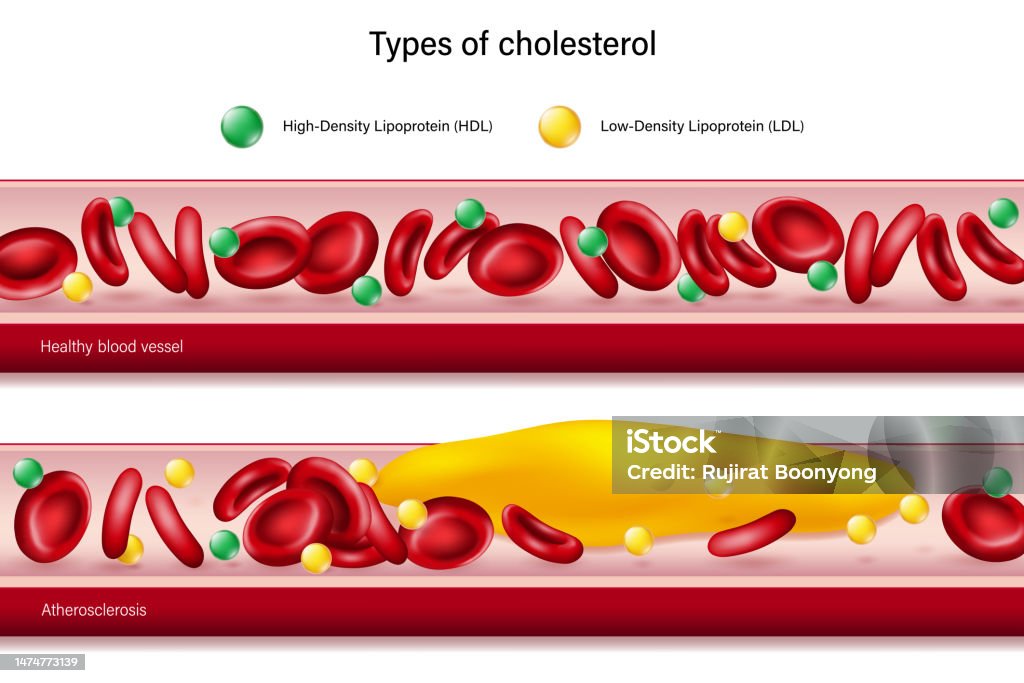 Types Of Cholesterol Highdensity Lipoprotein Comparison Of Healthy