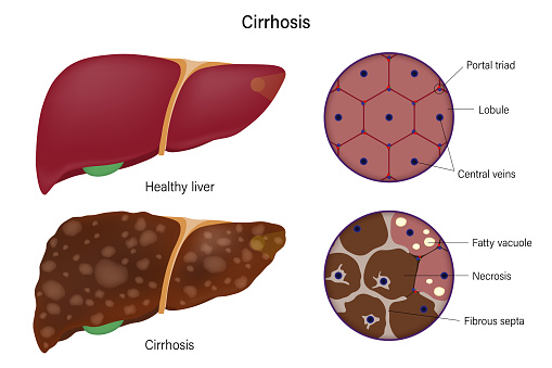 Histologie Du Foie Foie Normal Et Foie De Cirrhose Maladie Du Foie Pour Léducation Médicale Et