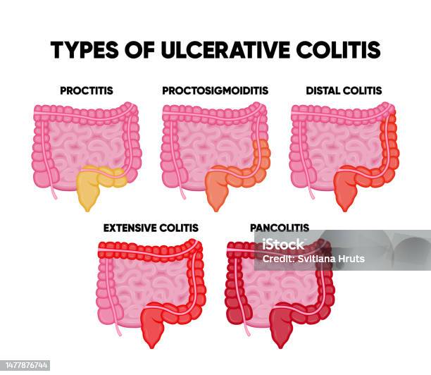 Ulcerative Colitis Types Infographics Including Proctitis Distal
