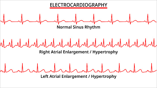 Set Of Ecg Common Abnormalities Right Atrial Enlargement Hypertrophy Vs ... Set Of Ecg Common Abnormalities Right Atrial Enlargement Hypertrophy Vs ...