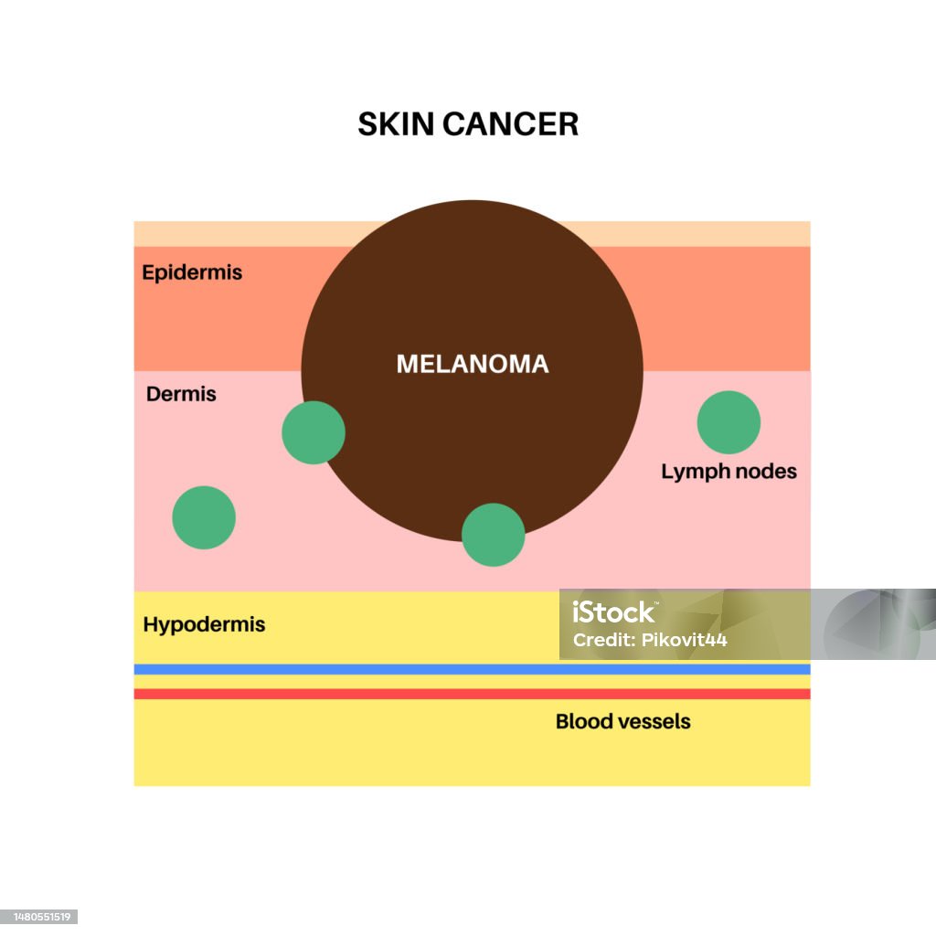 Melanoma Graphic Poster Stock Illustration Download Image Now Analyzing Anatomy Asymmetry