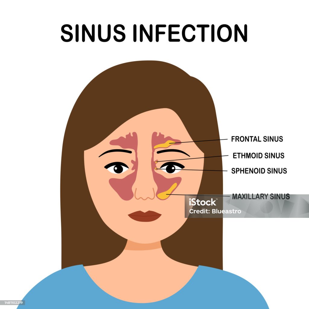 Ilustración De Infografía De Sinusitis O Infección Sinusal En Diseño