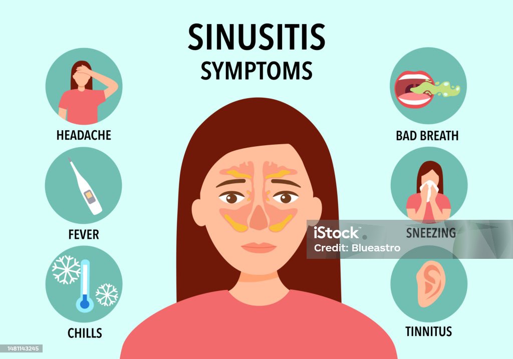 Ilustración De Sinusitis Síntomas Infografía Concepto Vectorial
