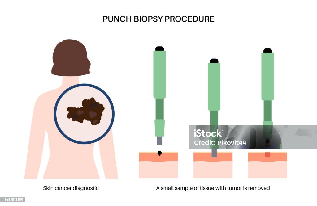 Skin Punch Biopsy For Neuropathy