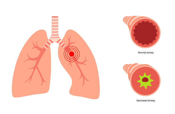 40 Bronchiolitis Stockillustraties Royalty Free Vector Illustraties