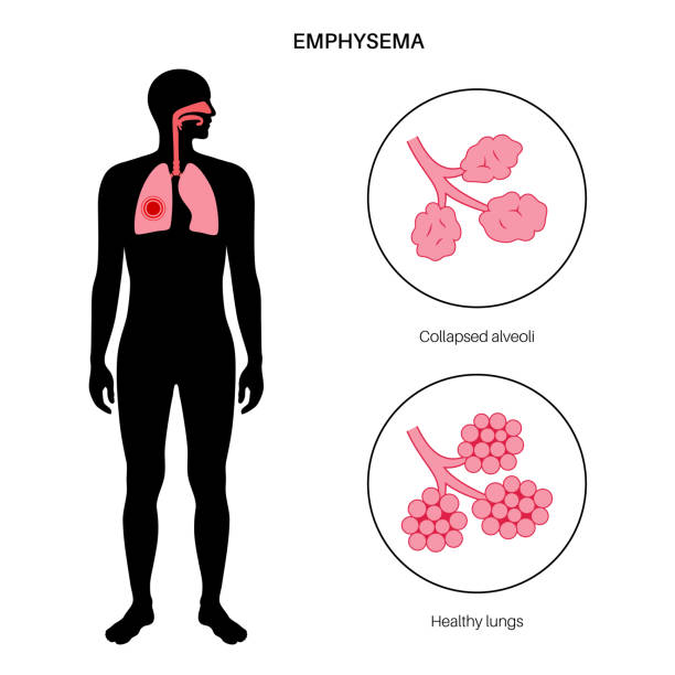 120+ Alveoli Damage Stock Illustrations, Royalty-Free Vector Graphics ... 120+ Alveoli Damage Stock Illustrations, Royalty-Free Vector Graphics ...