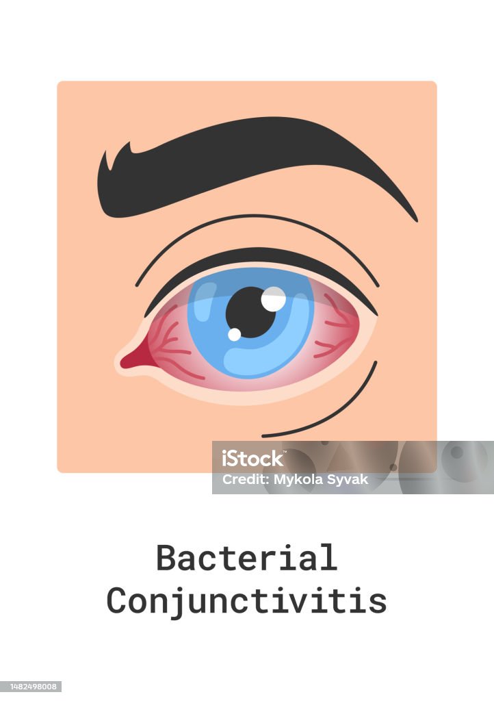 Ilustración De Conjuntivitis Bacteriana Enfermedad Ocular Y Más