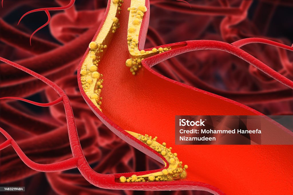 Cholesterol Blocked Artery The Accumulation Of Cholesterol In The Blood ... Cholesterol Blocked Artery The Accumulation Of Cholesterol In The Blood ...