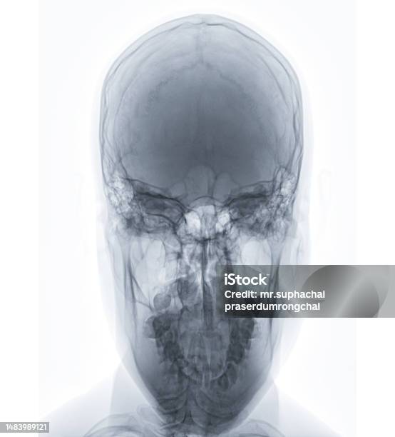 Xray Image Of Human Skull Towns View For Diagnosis Skull Fracture