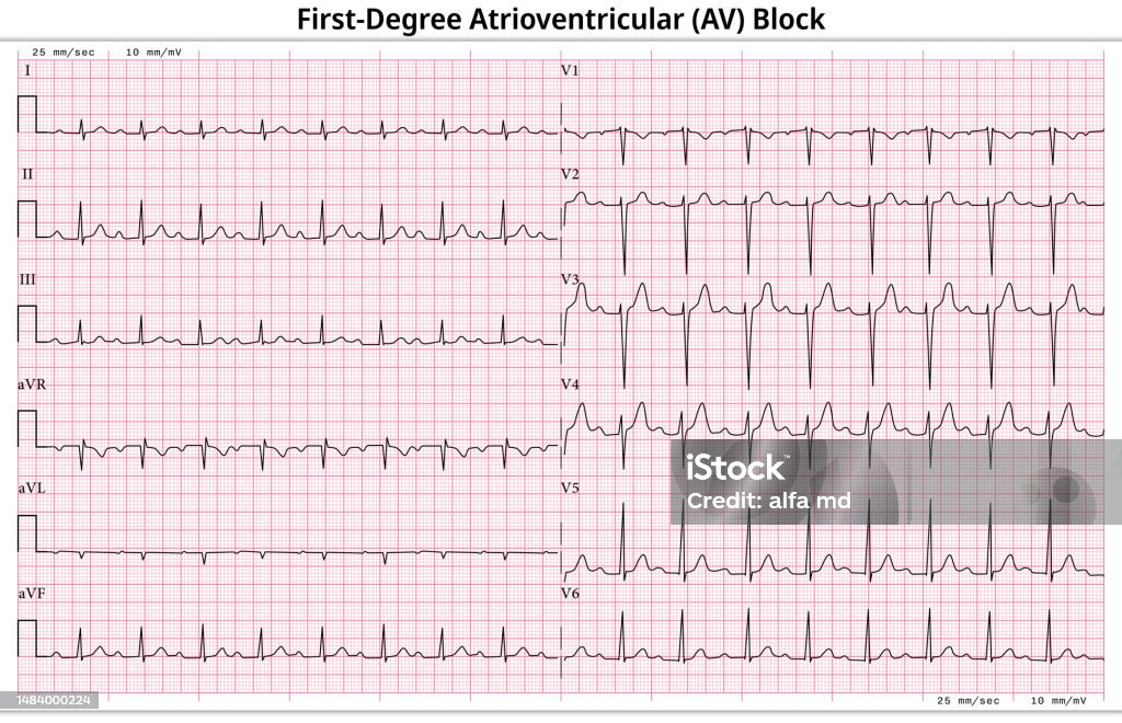 Ekg Blok Atrioventrikular Tingkat Pertama Blok Av Tingkat 1 12 Timbal ... Ekg Blok Atrioventrikular Tingkat Pertama Blok Av Tingkat 1 12 Timbal ...