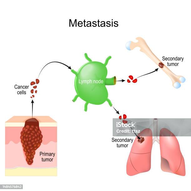 Metastasis Cancer Invasion Malignant Tumor Stock Illustration ... Metastasis Cancer Invasion Malignant Tumor Stock Illustration ...