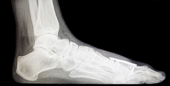 Xray Image Of Bone Block Distraction Arthrodesis Mtp1 Of The Hallux Metatarsophalangeal Joint
