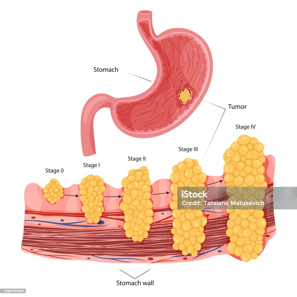 Stomach Cancer Stages Growth Malignant Cancerous Tumor Anatomical