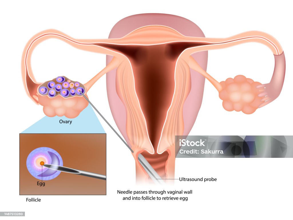 Ivf Egg Retrieval Technique Egg Retrieval Procedure Before In Vitro Fertilization Stock