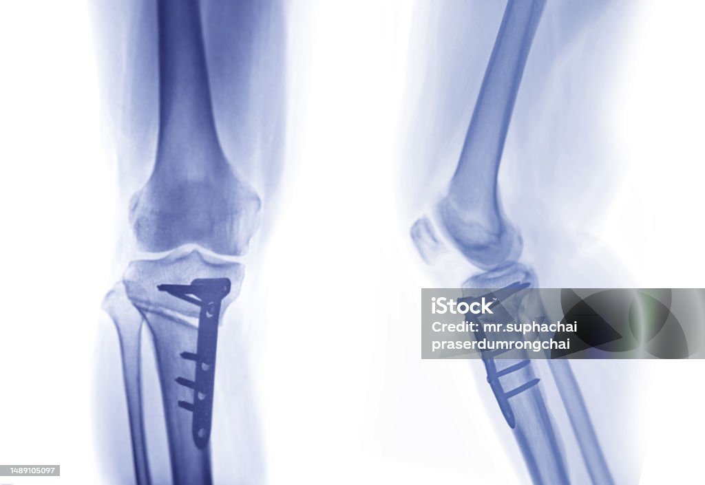 Gambar Xray Ap Lutut Kanan Dan Tampilan Lateral Menunjukkan Artroplasti ... Gambar Xray Ap Lutut Kanan Dan Tampilan Lateral Menunjukkan Artroplasti ...