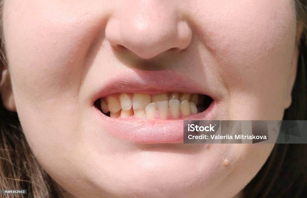 Patient Woman With Dislocated Jaw And Malocclusion Temporomandibular