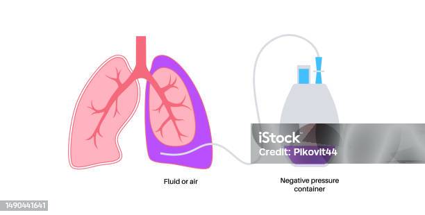 Ilustración de Catéter Pleural Tunelizado y más Vectores Libres de ... Ilustración de Catéter Pleural Tunelizado y más Vectores Libres de ...