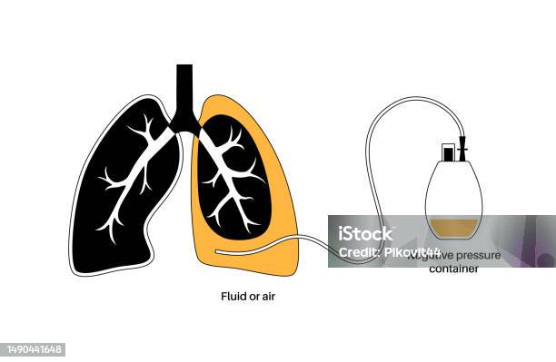 Ilustración de Catéter Pleural Tunelizado y más Vectores Libres de ... Ilustración de Catéter Pleural Tunelizado y más Vectores Libres de ...