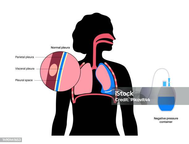 Ilustración de Catéter Pleural Tunelizado y más Vectores Libres de ... Ilustración de Catéter Pleural Tunelizado y más Vectores Libres de ...
