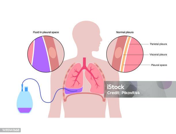 Ilustración de Catéter Pleural Tunelizado y más Vectores Libres de ... Ilustración de Catéter Pleural Tunelizado y más Vectores Libres de ...