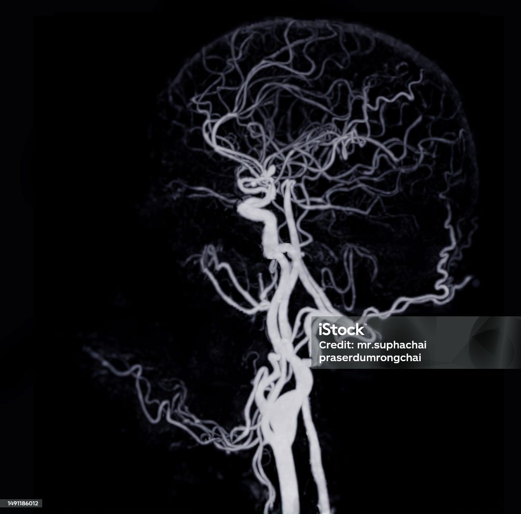 Angiografía Por Tc Del Cerebro O Cta Cerebral Que Muestra Areriedad Cerebral Foto De Stock Y Más