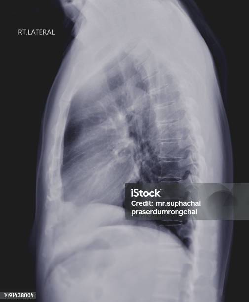 Rontgen Dada Atau Xray Image Of Human Lung Lateral View Dengan