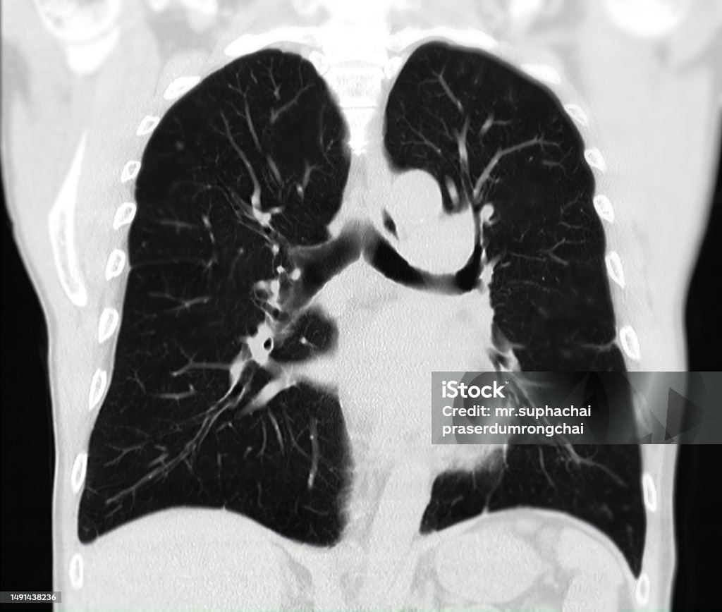 Ct Scan Dada Atau Paruparu Untuk Skrining Nodul Paruparu Dan Kanker