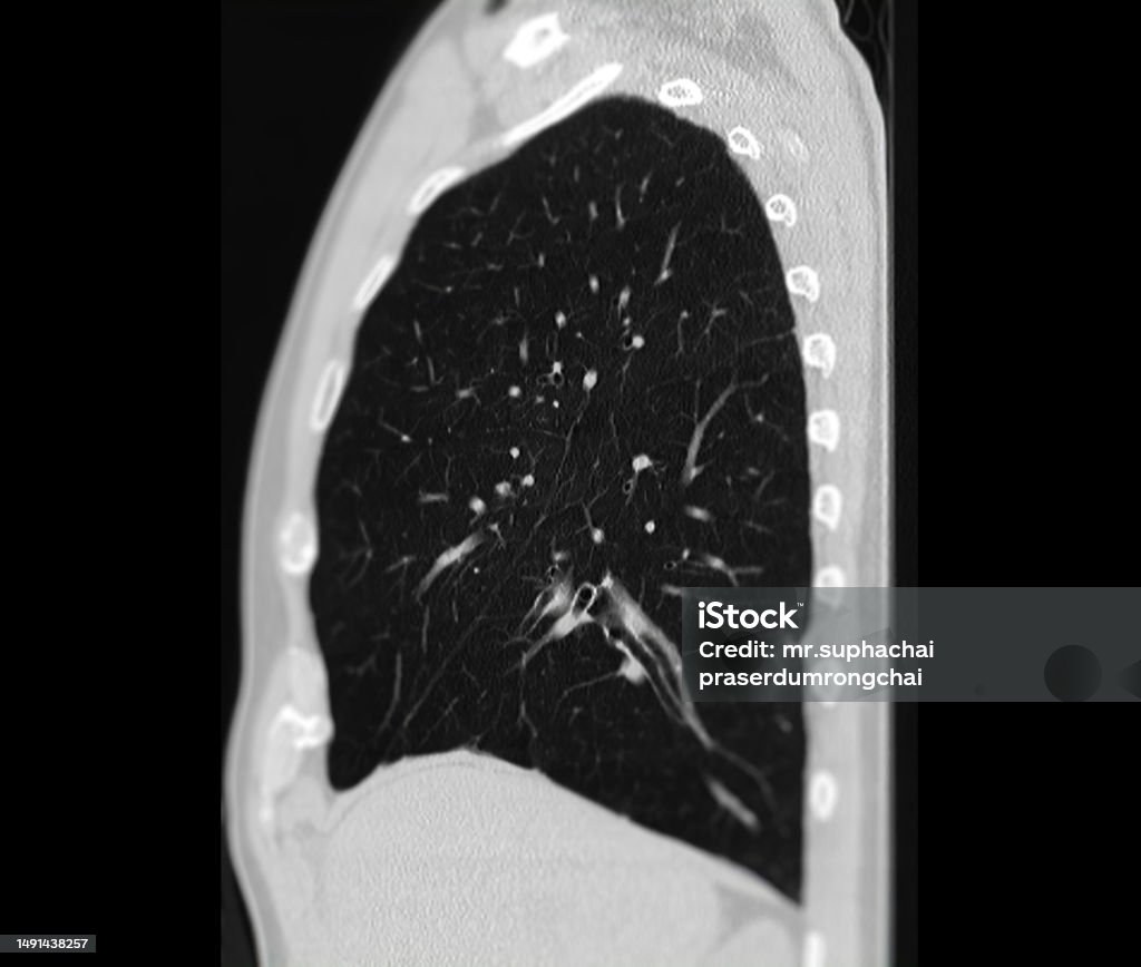 Ct Scan Dada Atau Paruparu Untuk Skrining Nodul Paruparu Dan Kanker