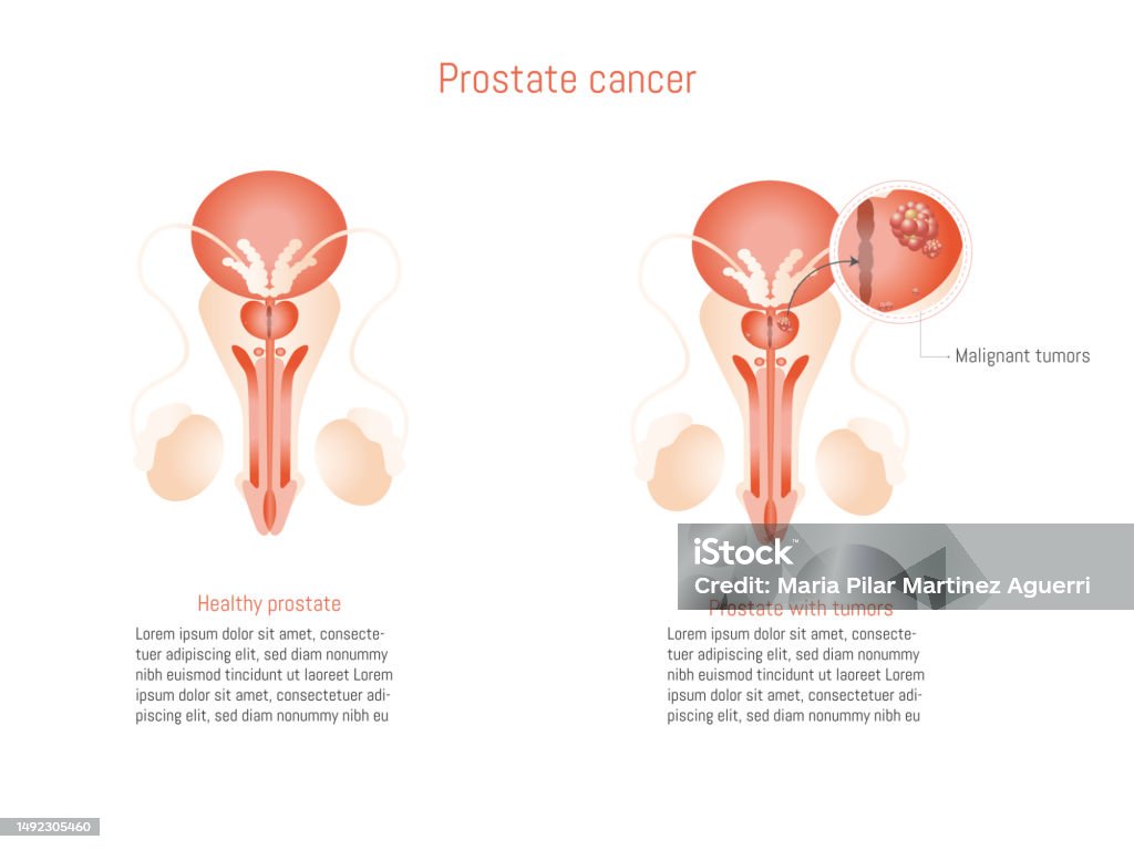 Prostate Cancer Infographic On White Background Illustration Stock